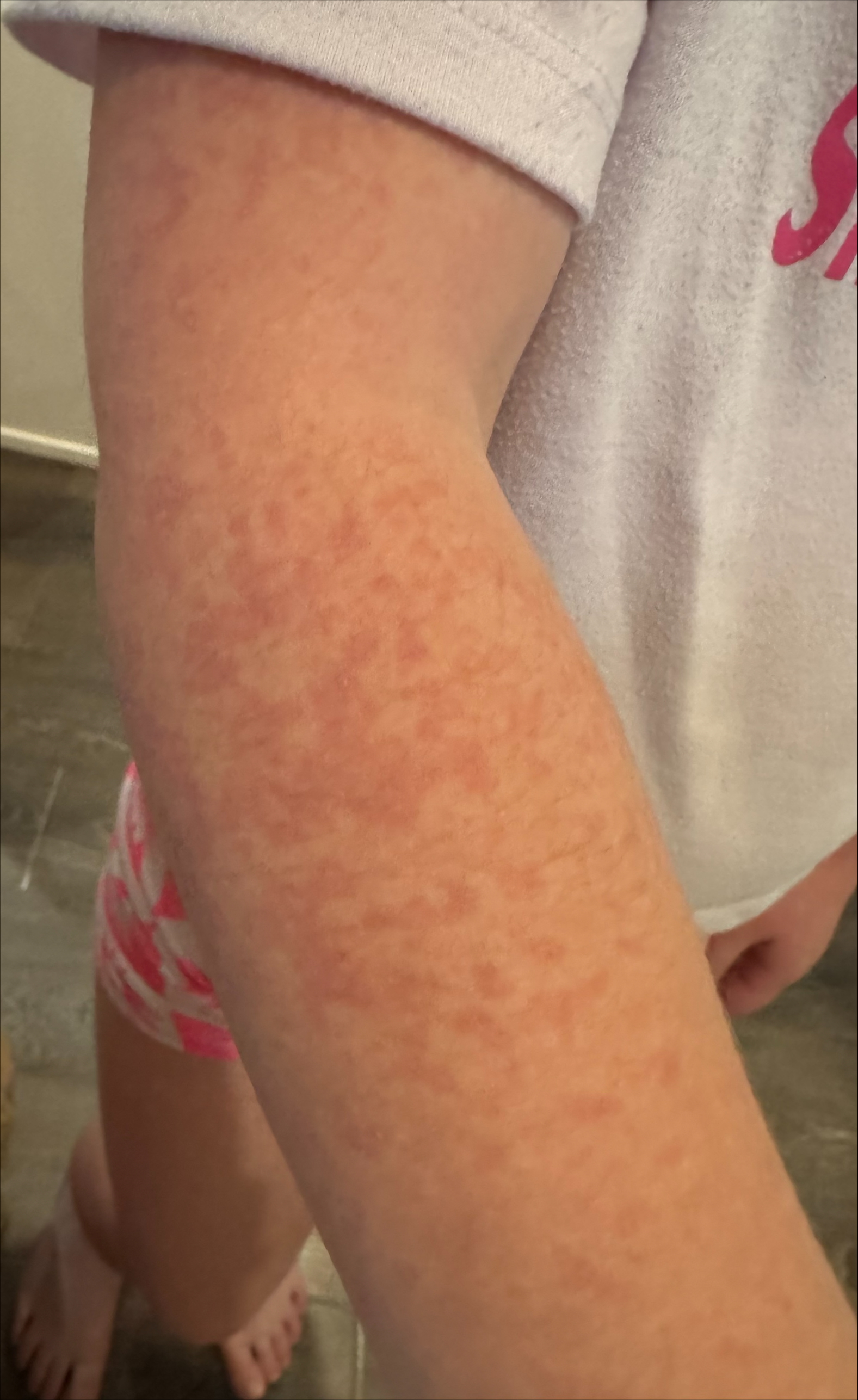 Rash outbreak at Cochrane Christian Academy - CochraneNow: Cochrane ...